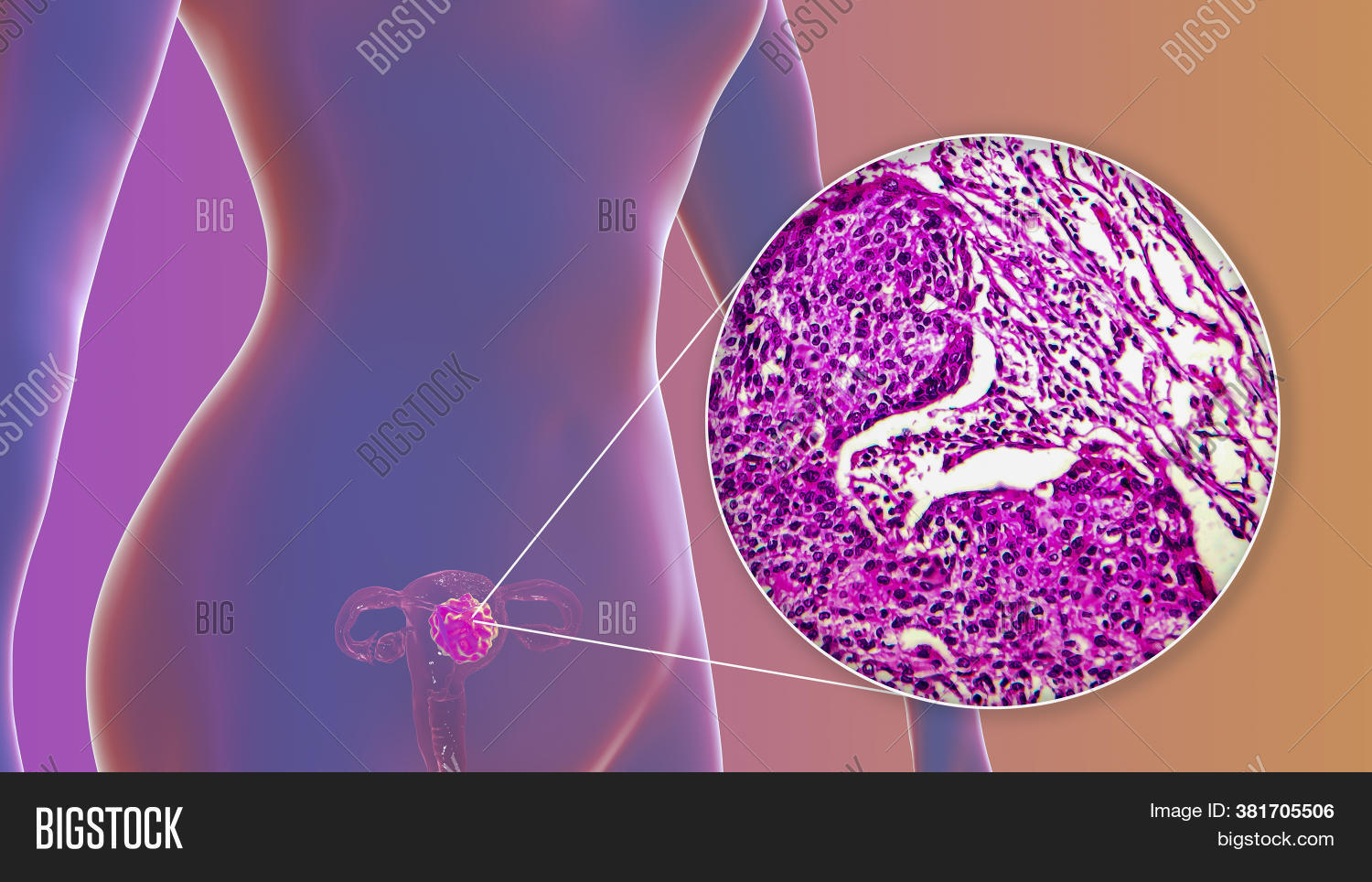 Uterine Cancer, 3d Image & Photo (Free Trial) | Bigstock