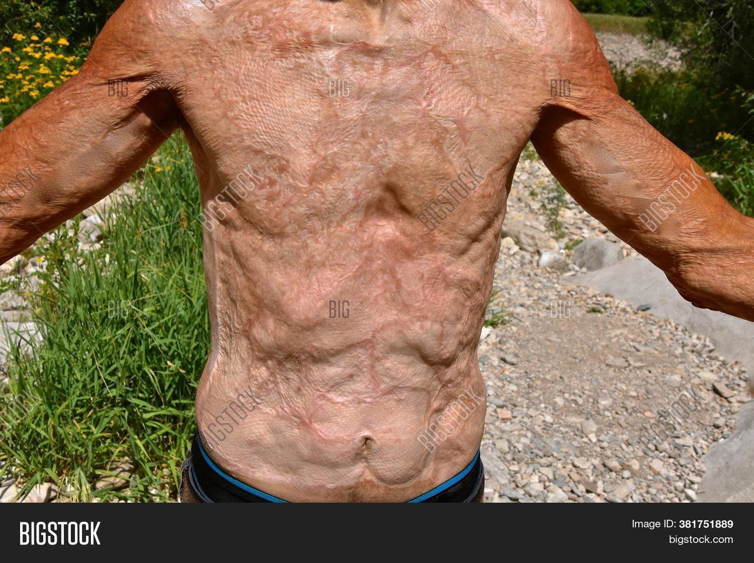 Scars On Male Body Image & Photo (Free Trial) | Bigstock