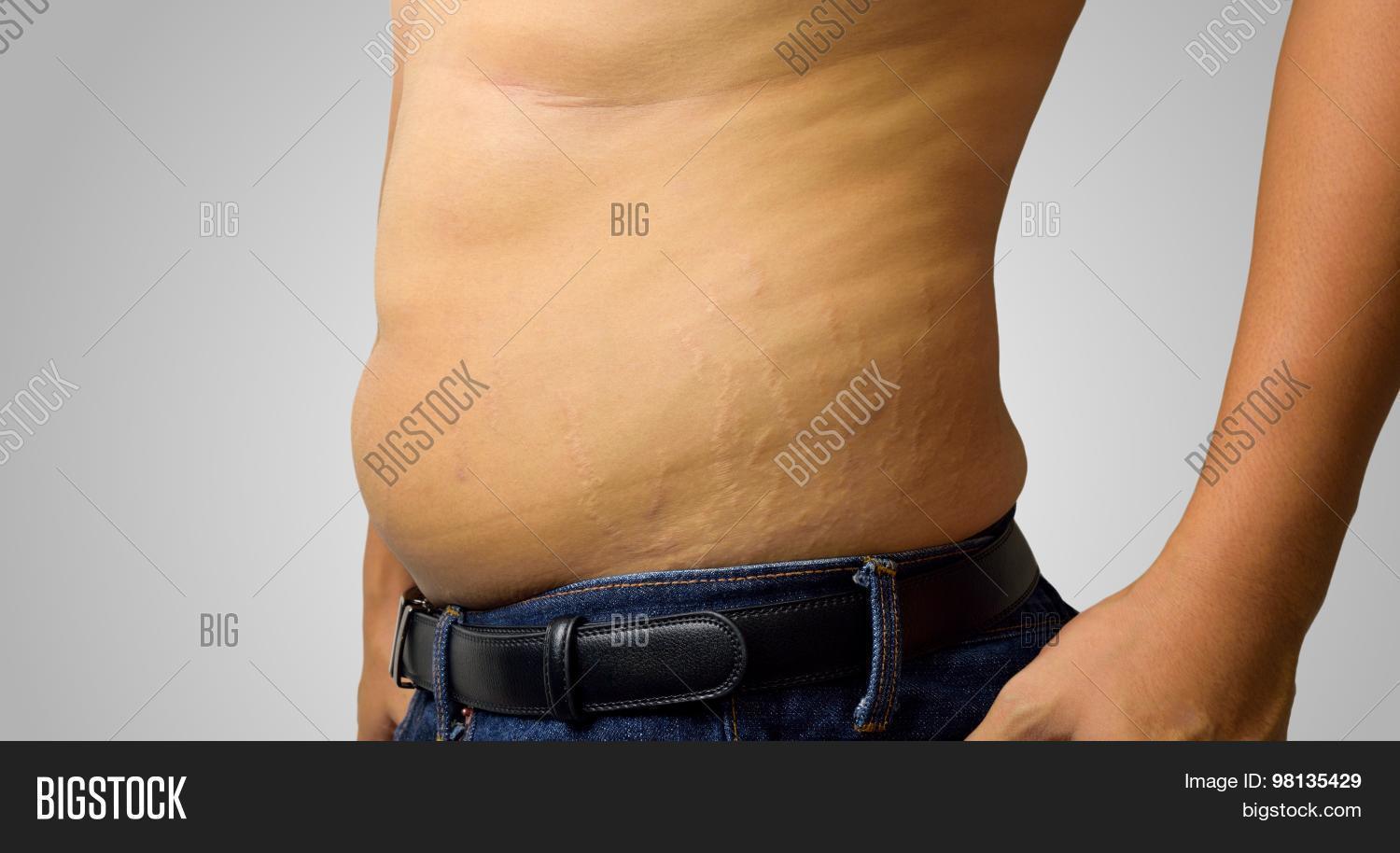 Skin Stretch Image & Photo (Free Trial) | Bigstock