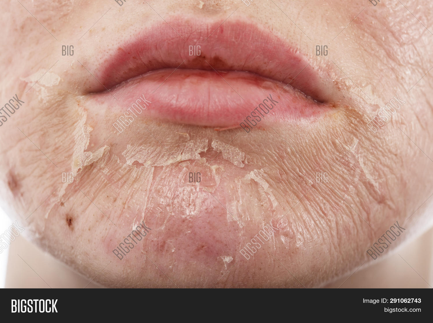 Female Face Burned Image & Photo (Free Trial) | Bigstock