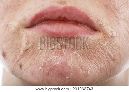 Female Face Burned Image & Photo (Free Trial) | Bigstock