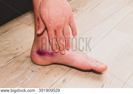 Sprained Ligaments On Image & Photo (Free Trial) | Bigstock