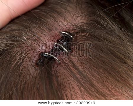 Head Wound - Staples Image & Photo (Free Trial) | Bigstock