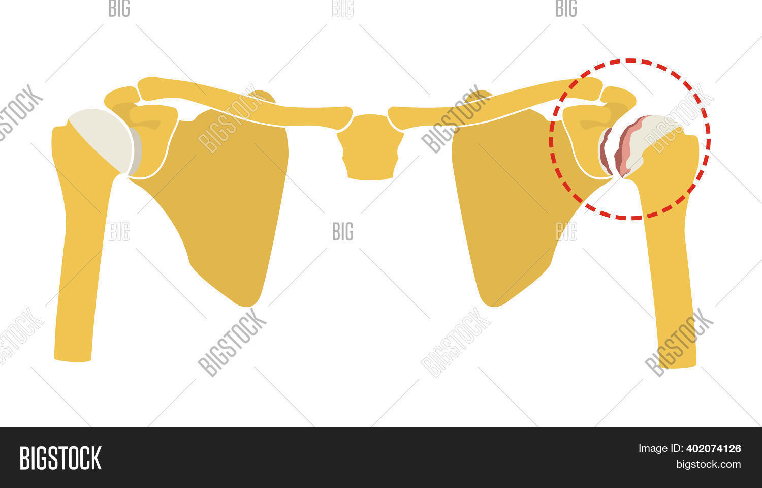 Osteoarthritis Image & Photo (Free Trial) | Bigstock