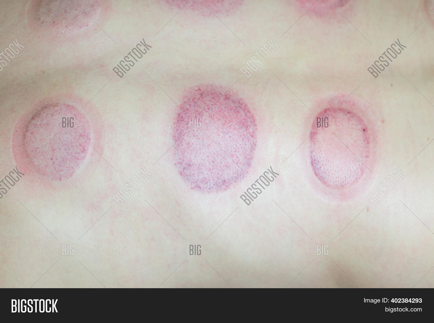 Bruises On Back After Image & Photo (Free Trial) | Bigstock