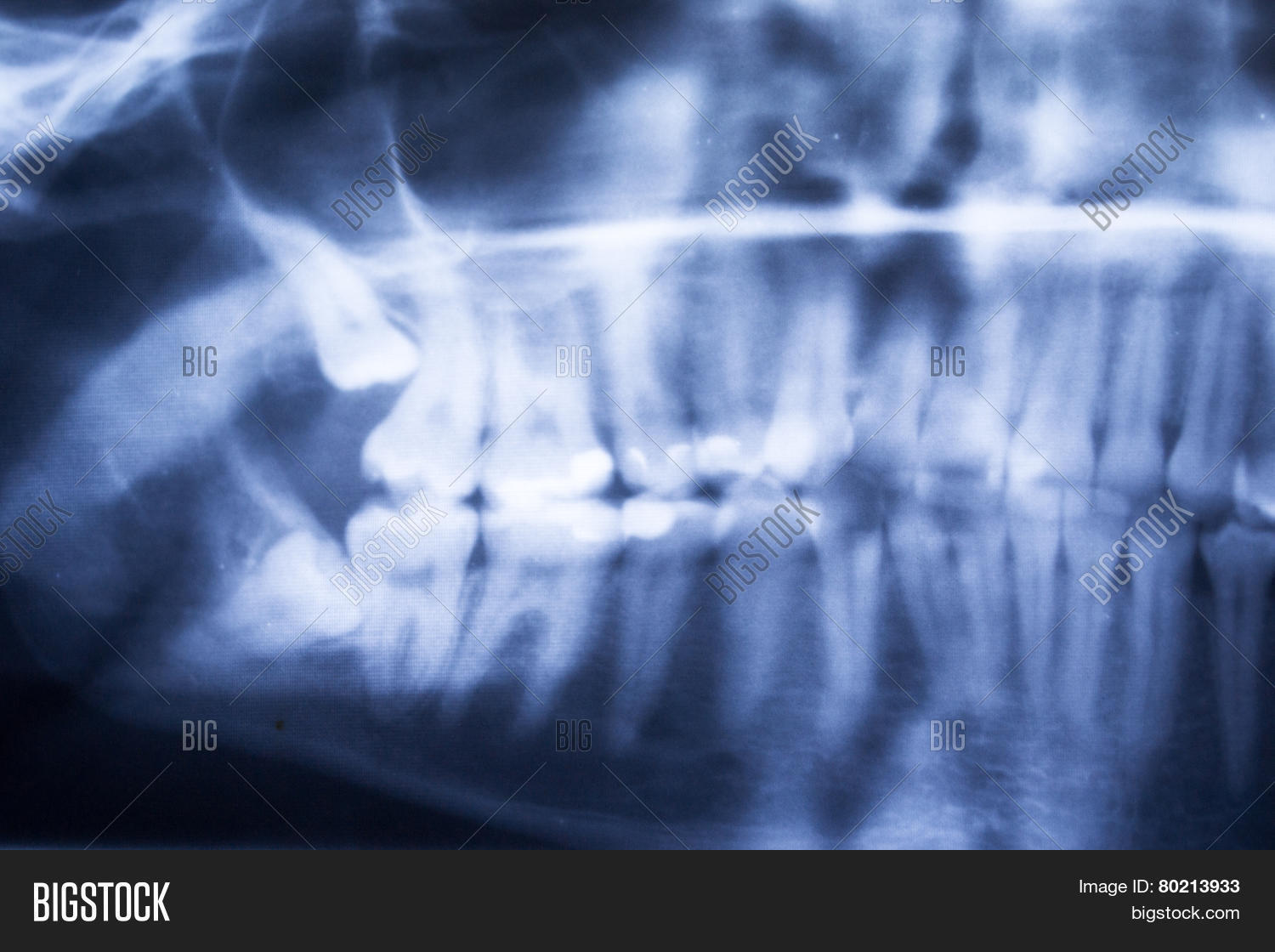 Panoramic Dental X-Ray Image & Photo (Free Trial) | Bigstock
