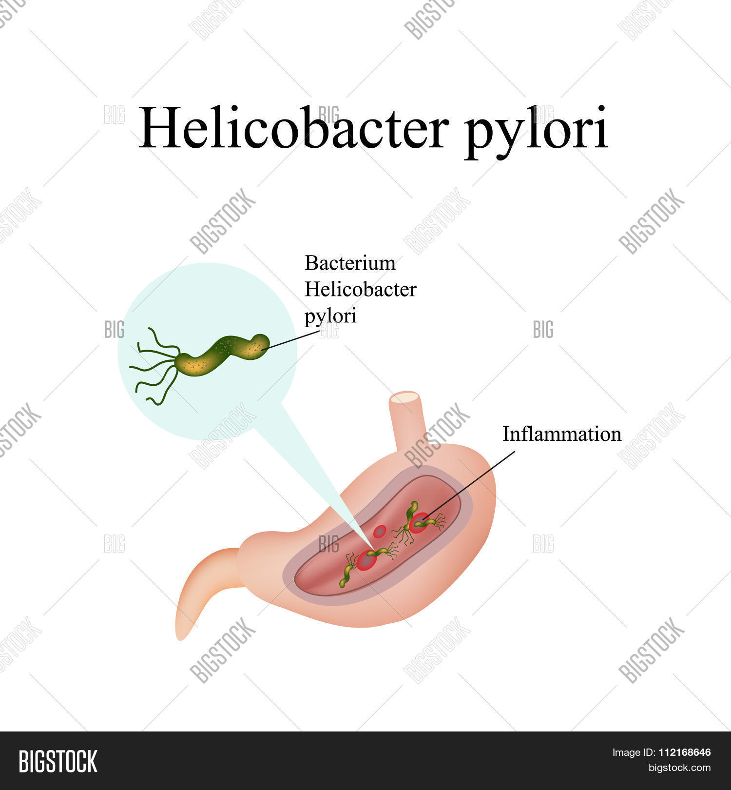 Helicobacter Pylori Vector & Photo (Free Trial) | Bigstock