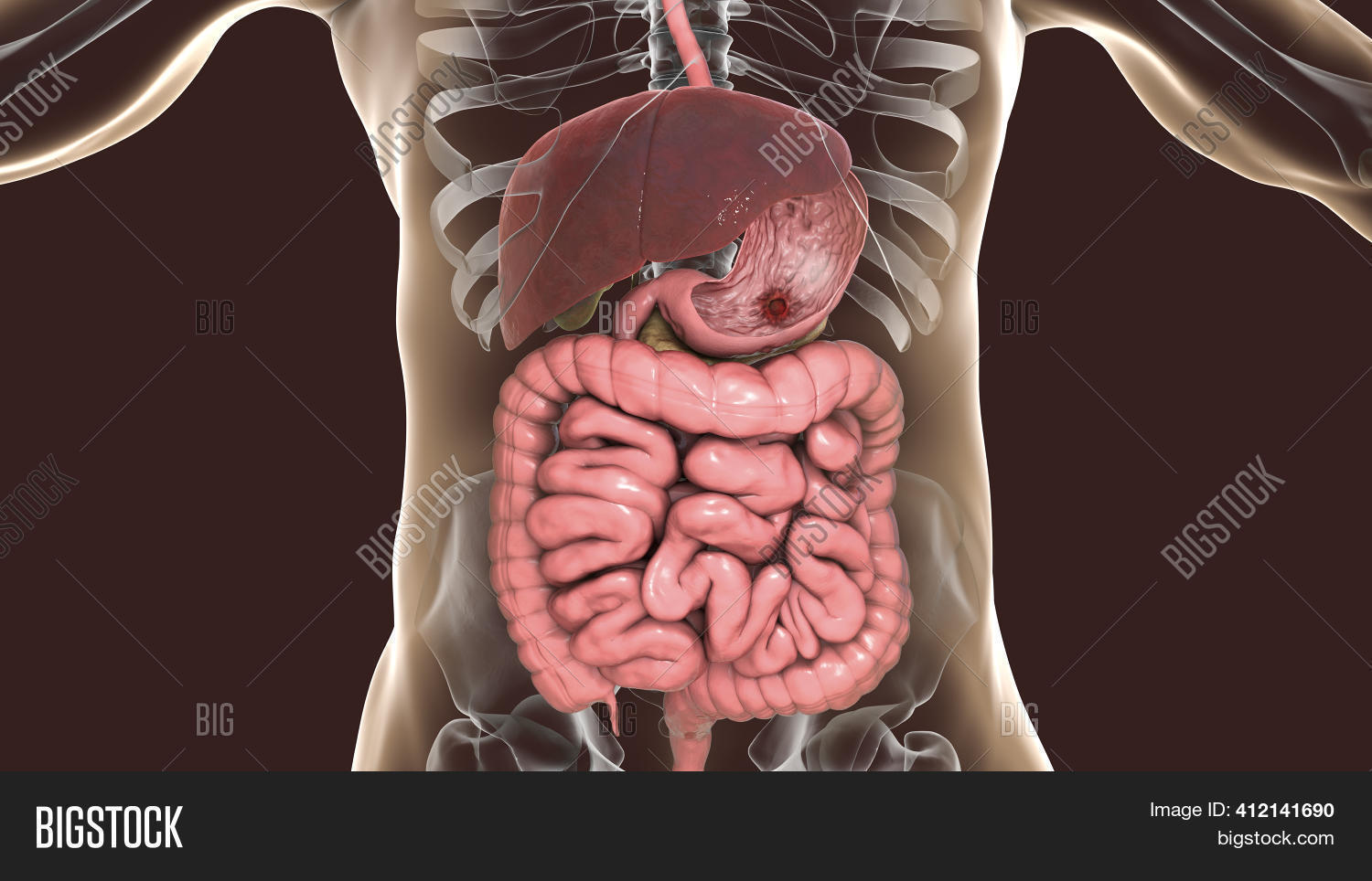Peptic Ulcer, 3d Image & Photo (Free Trial) | Bigstock