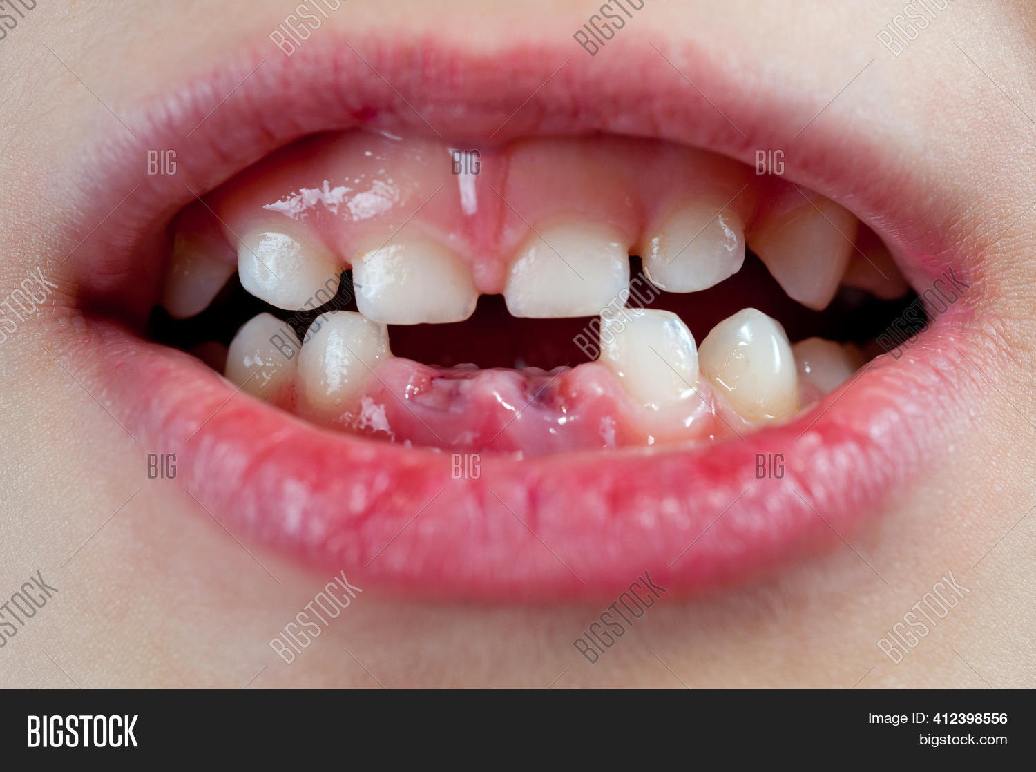 Child's Mouth Two Image & Photo (Free Trial) | Bigstock