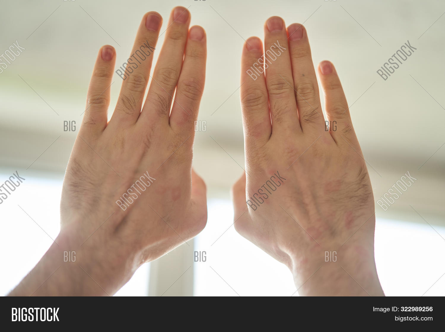 Skin Imperfection. Image & Photo (Free Trial) | Bigstock