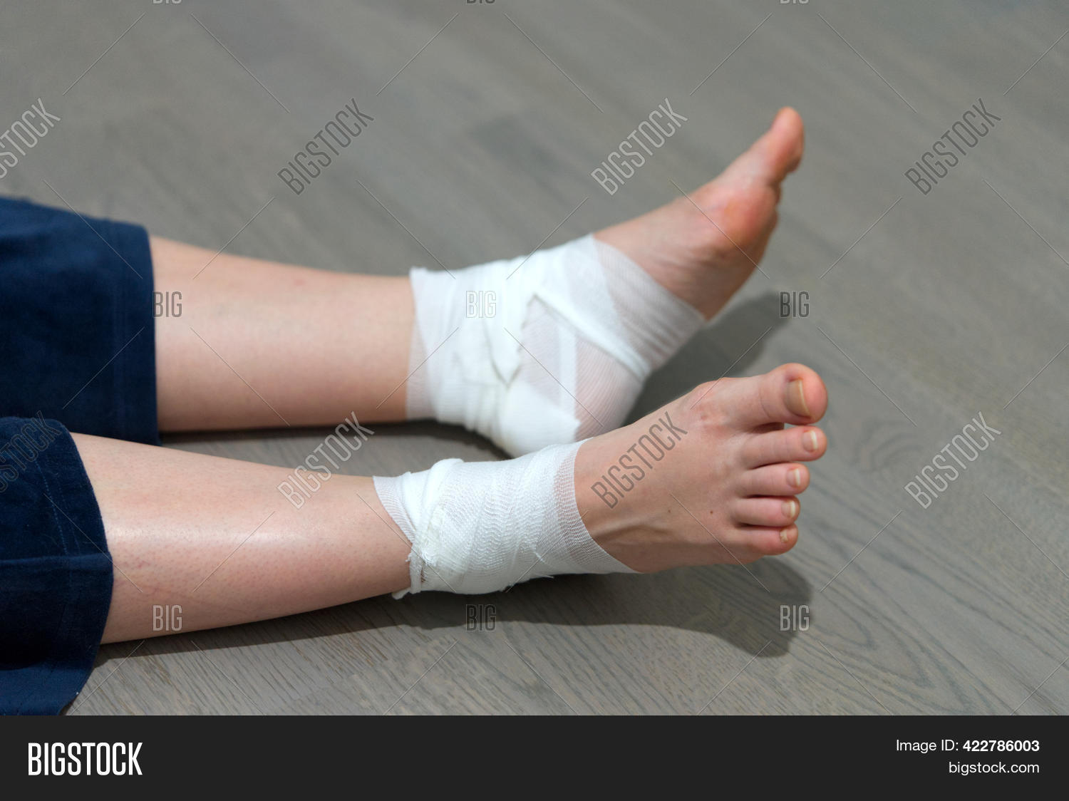 Callus On Leg. Girl Image & Photo (Free Trial) | Bigstock