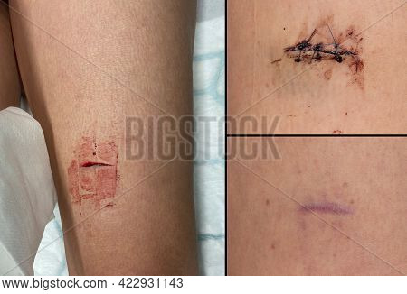 Healing Process Cut On Image & Photo (Free Trial) | Bigstock
