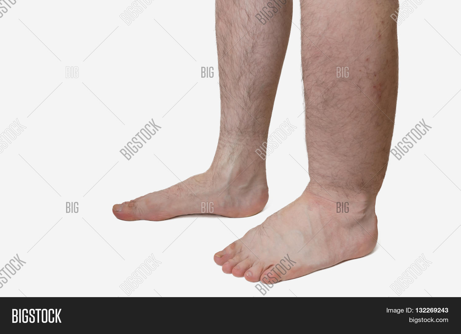 Leg Diseased Patient Image & Photo (Free Trial) | Bigstock
