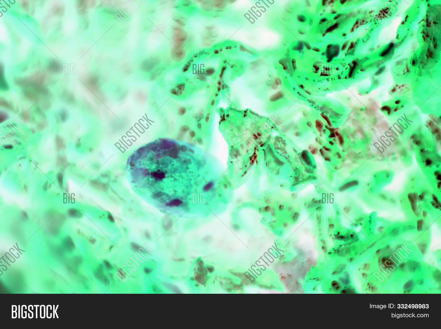 Cancer Cells Under Image & Photo (Free Trial) | Bigstock