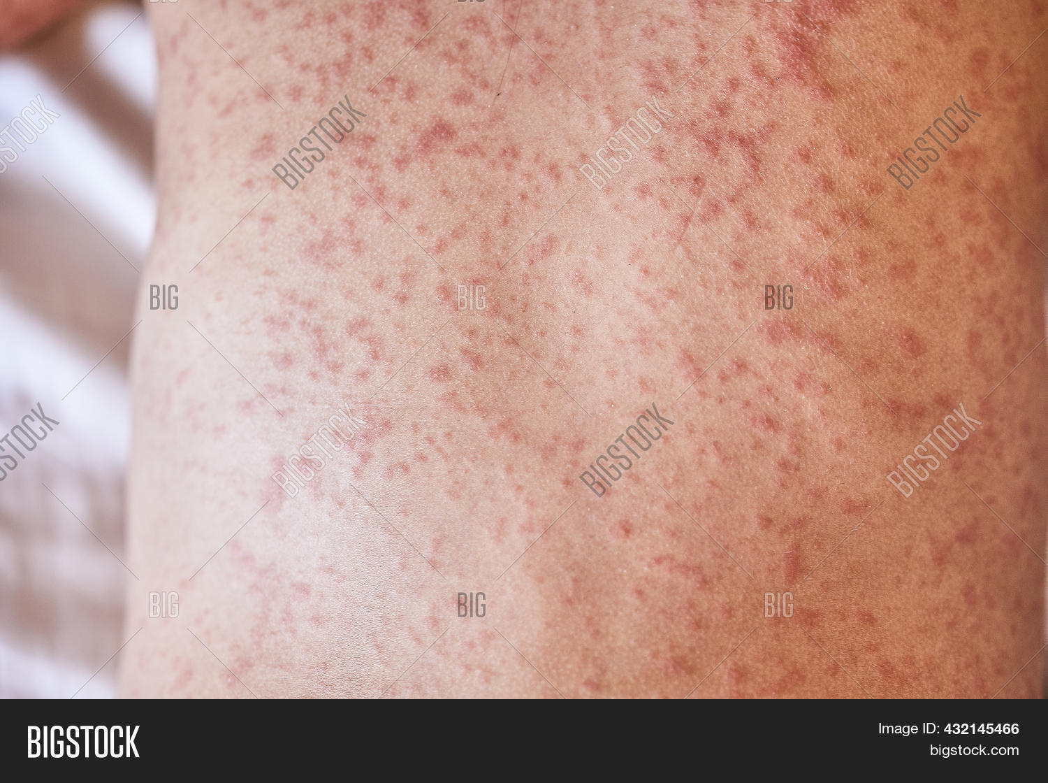 Allergic Rash On Body Image & Photo (Free Trial) | Bigstock