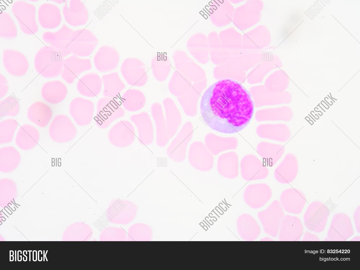 Reactive Lymphocytes Image & Photo (Free Trial) | Bigstock