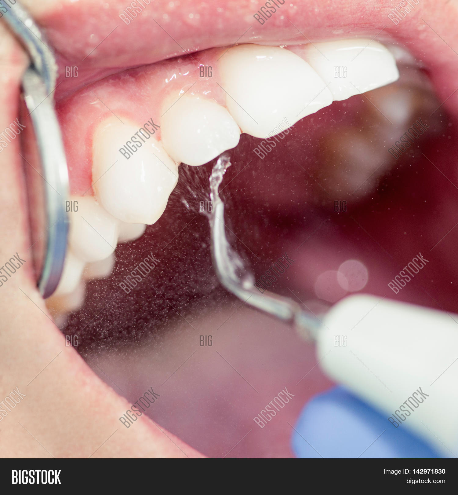 Removing Dental Plaque Image & Photo (Free Trial) | Bigstock
