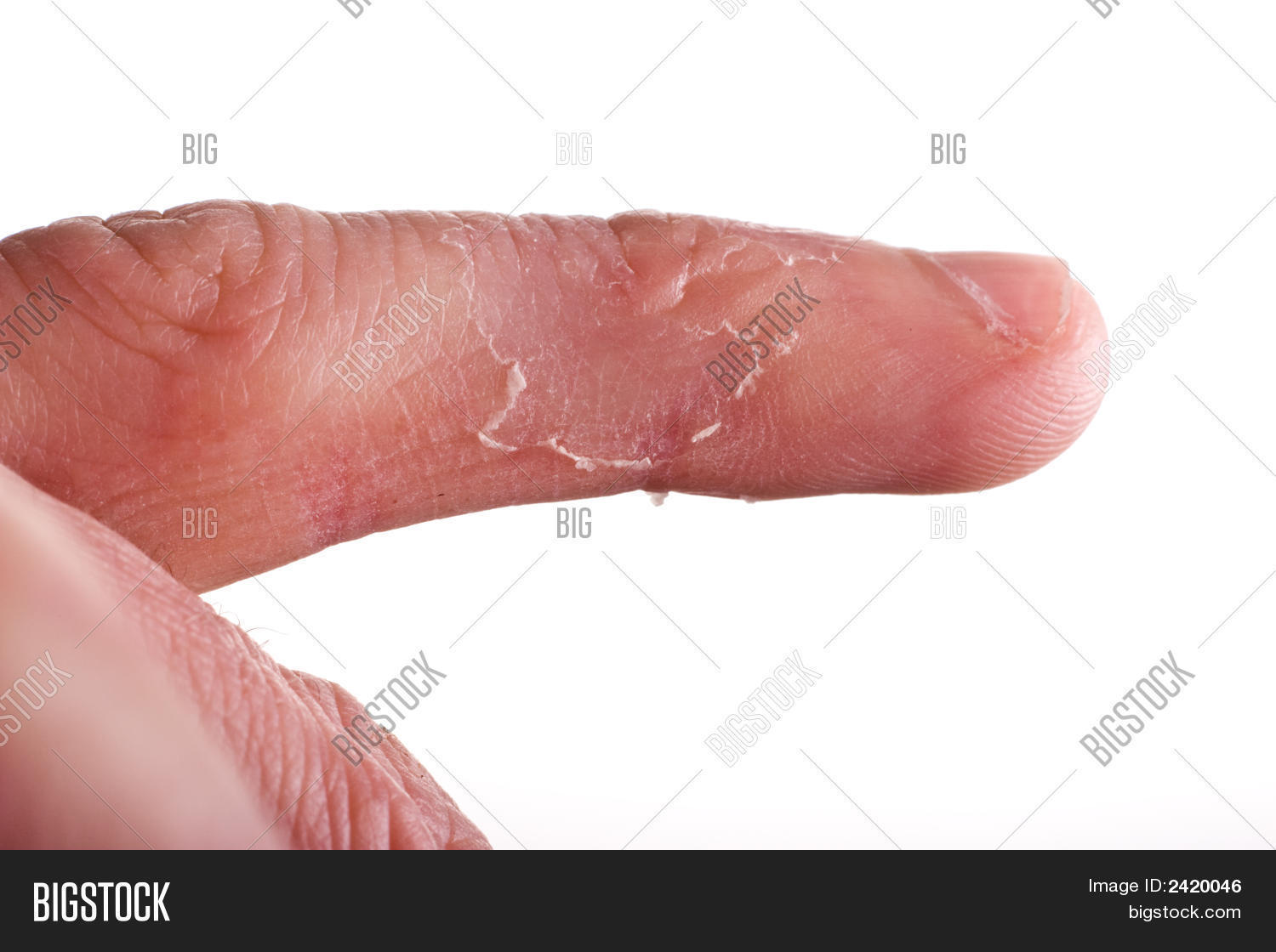 Eczema On Finger Image & Photo (Free Trial) | Bigstock