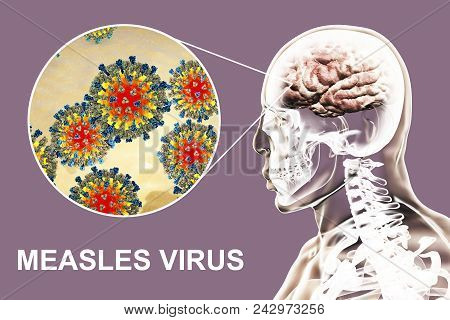Measles-induced Image & Photo (Free Trial) | Bigstock