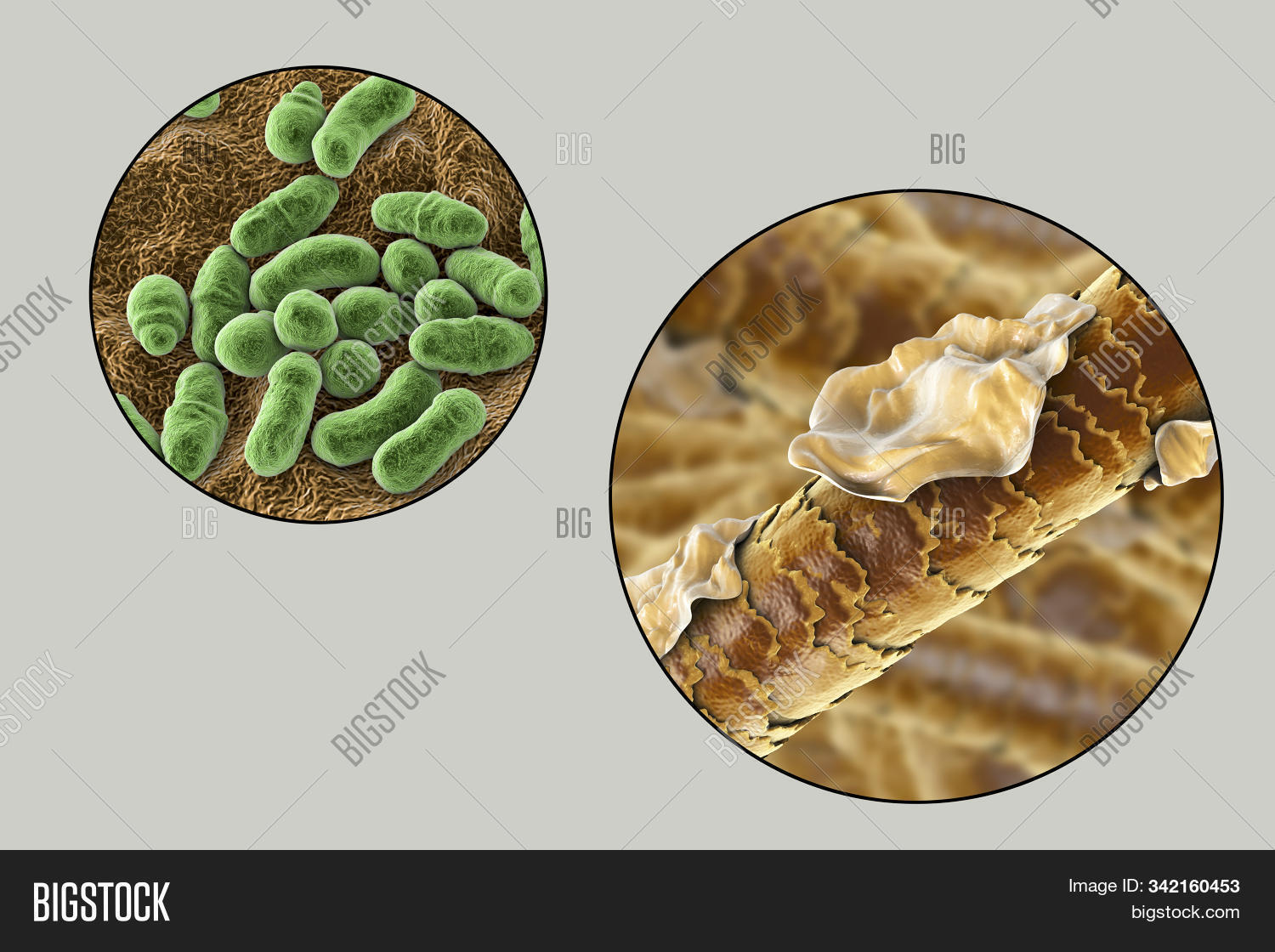 Human Hair Dandruff Image & Photo (Free Trial) | Bigstock