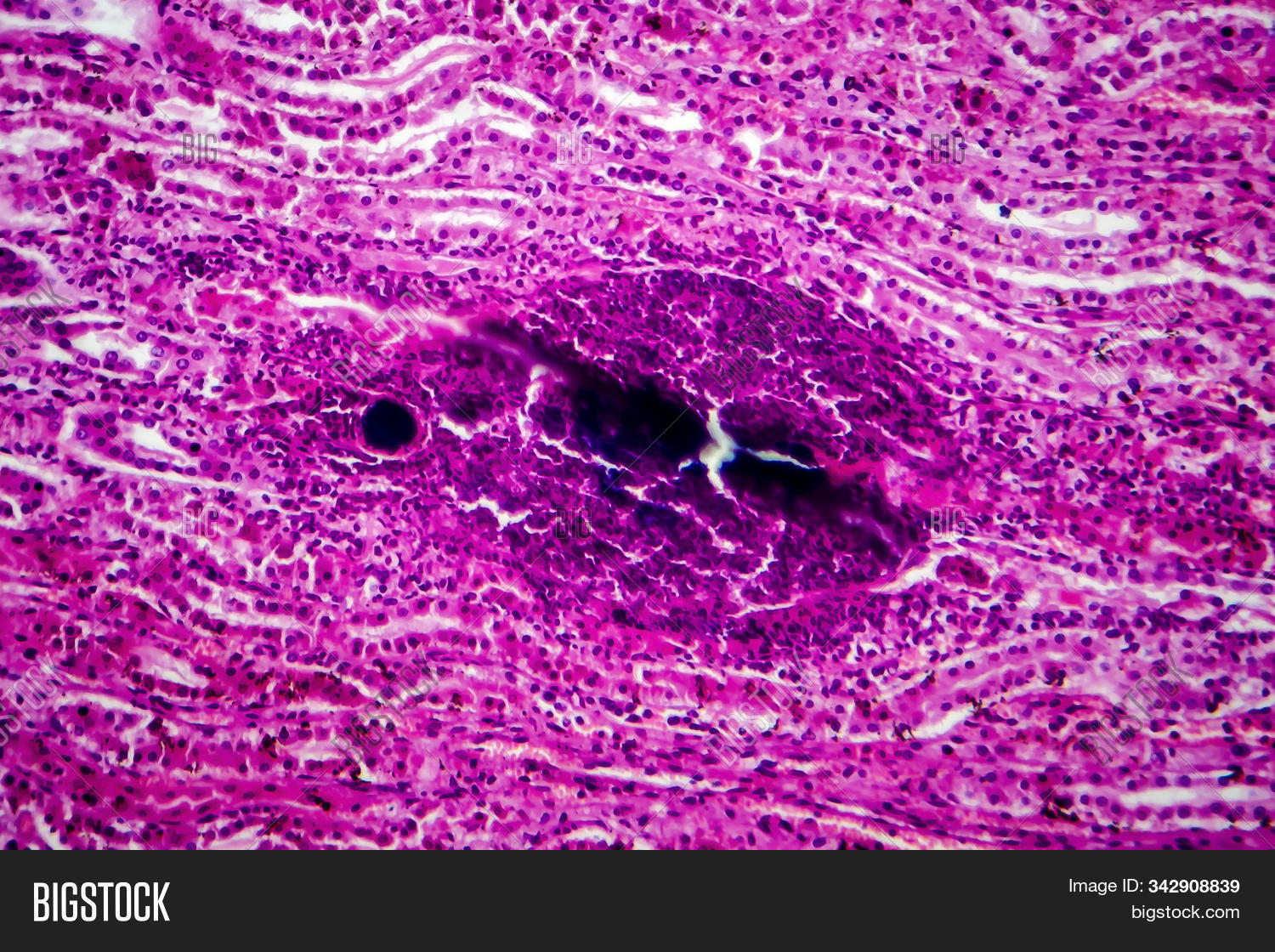 Acute Pyelonephritis, Image & Photo (Free Trial) | Bigstock