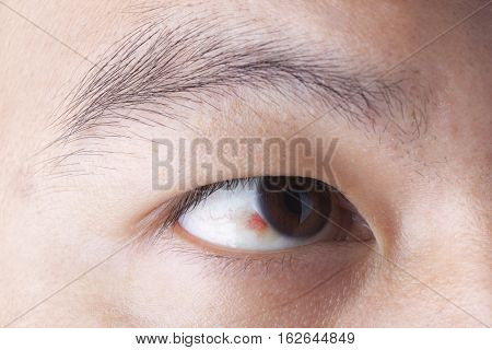 Close Subconjunctival Image & Photo (Free Trial) | Bigstock