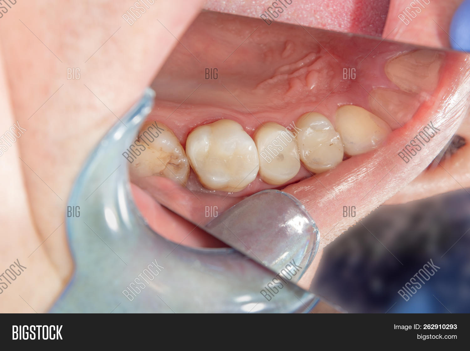 Dental Caries. Filling Image & Photo (Free Trial) | Bigstock