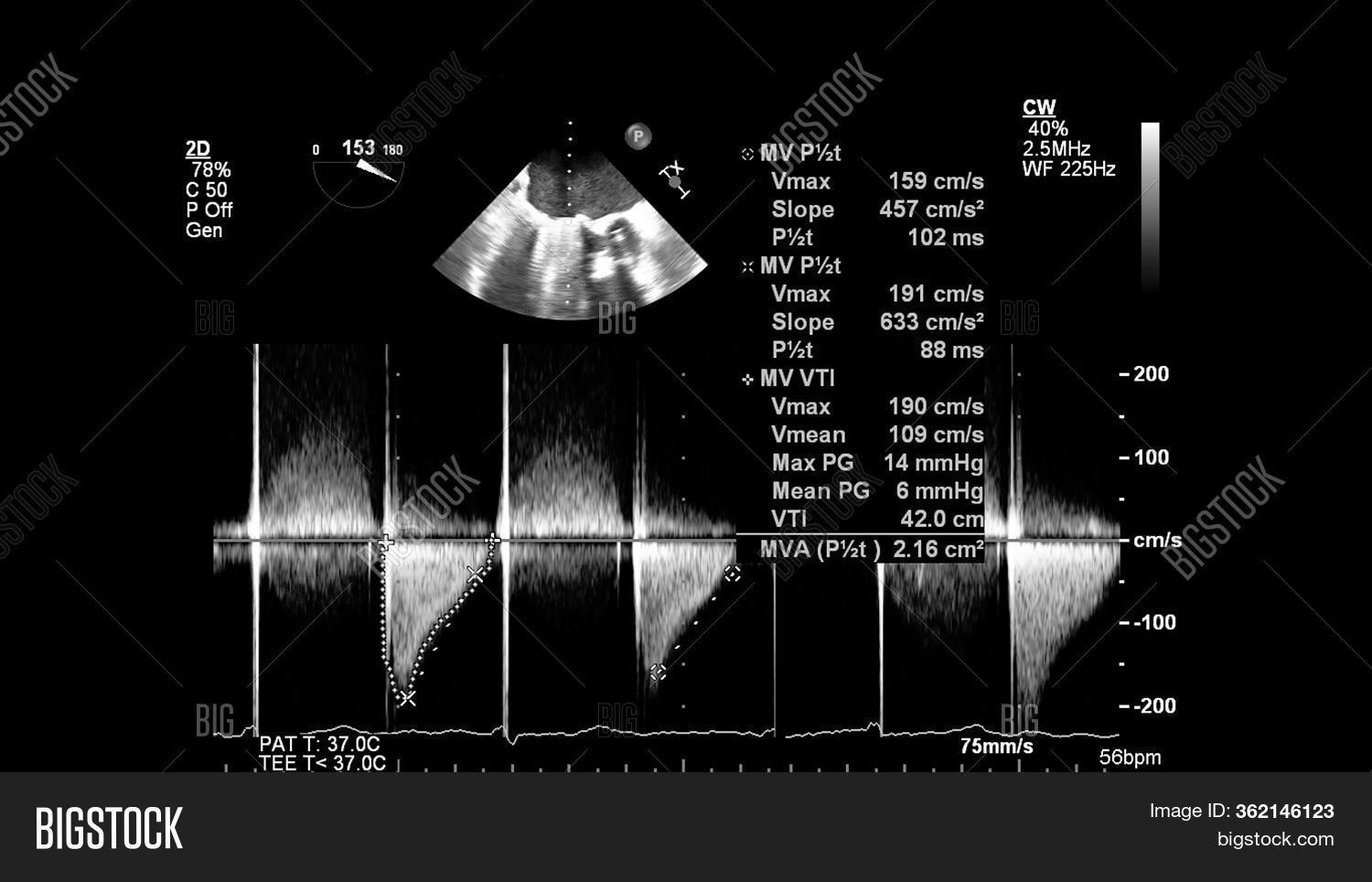 Image Heart Gray-scale Image & Photo (Free Trial) | Bigstock