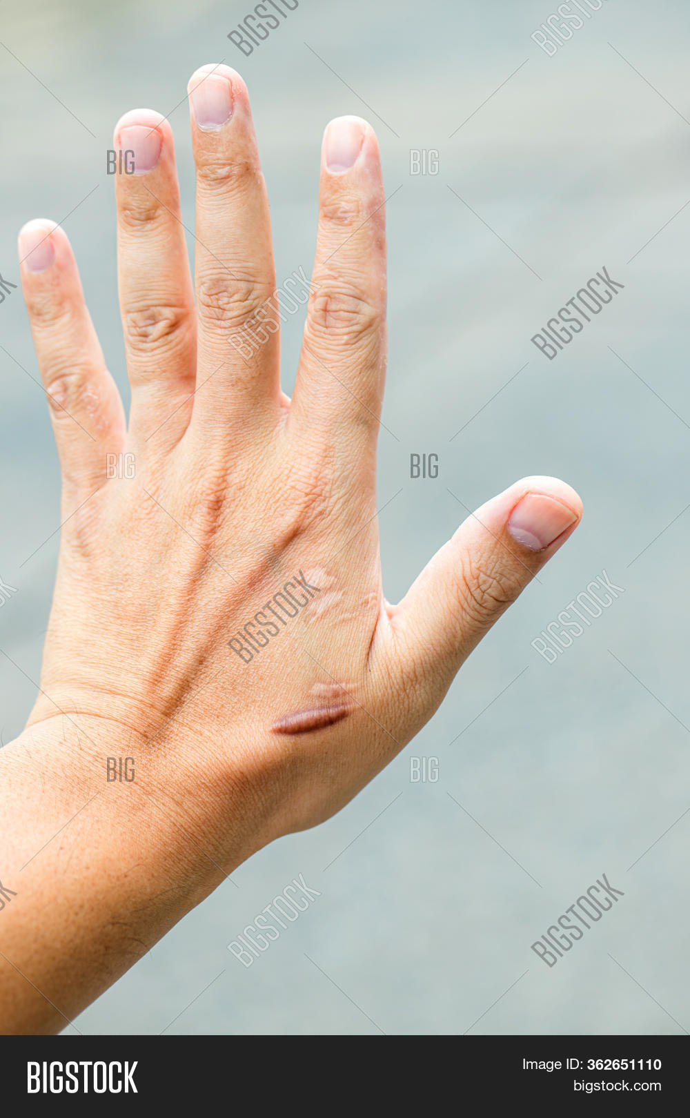 Keloid Scar ( Image & Photo (Free Trial) | Bigstock