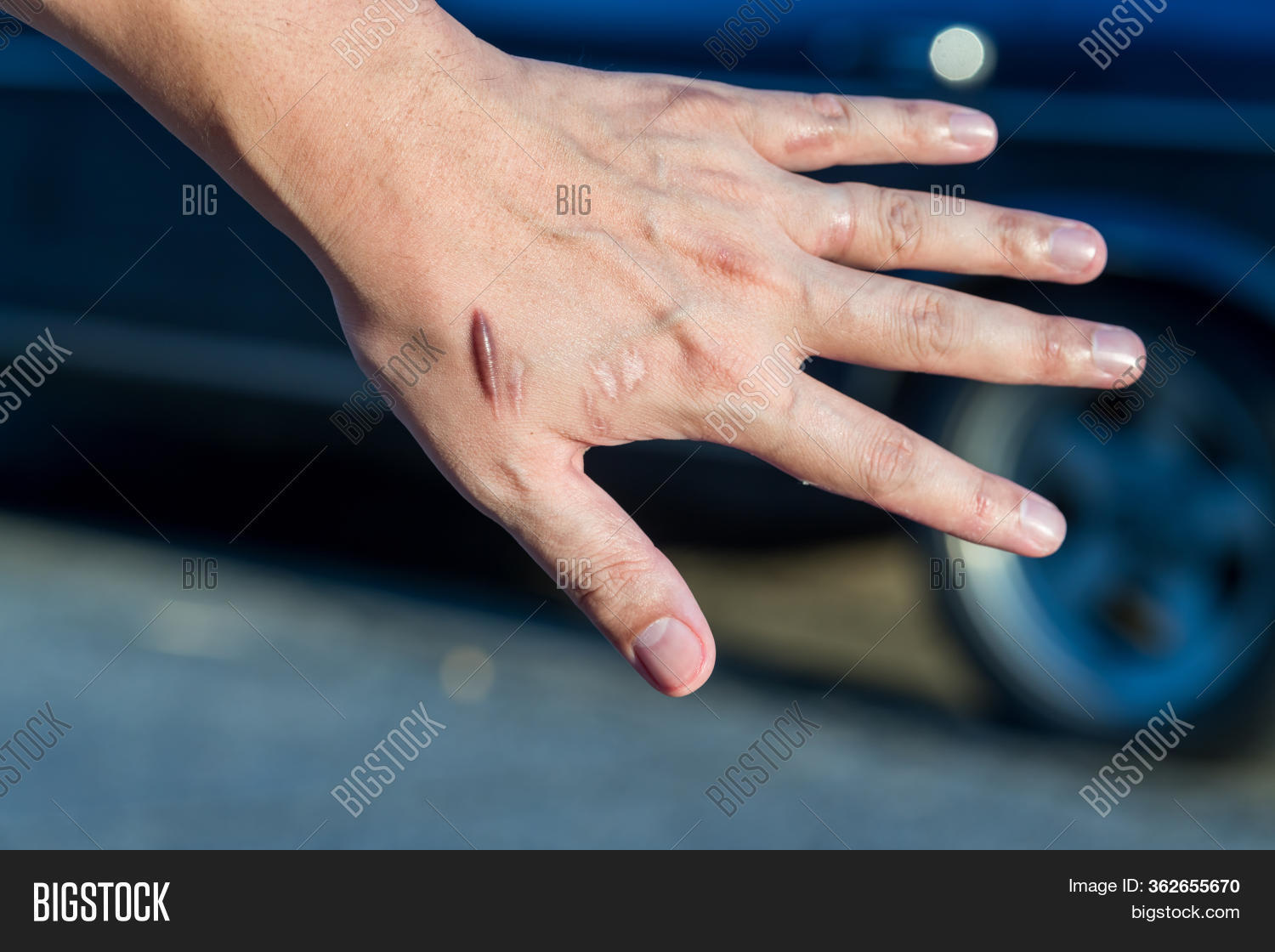 Keloid Scar ( Image & Photo (Free Trial) | Bigstock