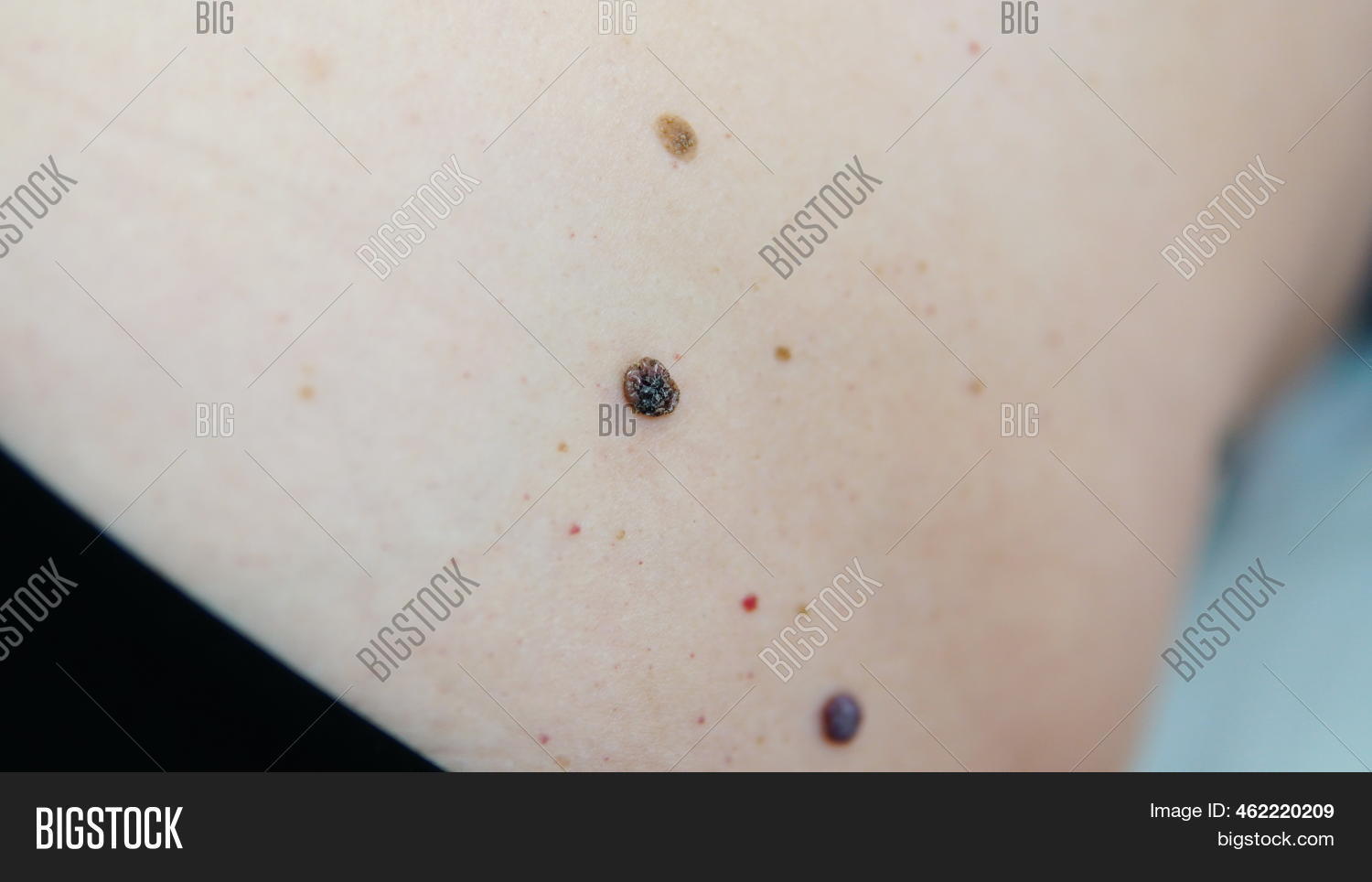 Red Moles Dots On Image & Photo (Free Trial) | Bigstock