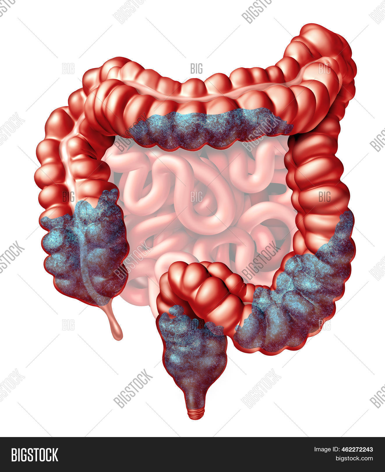 Constipation Anatomy Image & Photo (Free Trial) | Bigstock