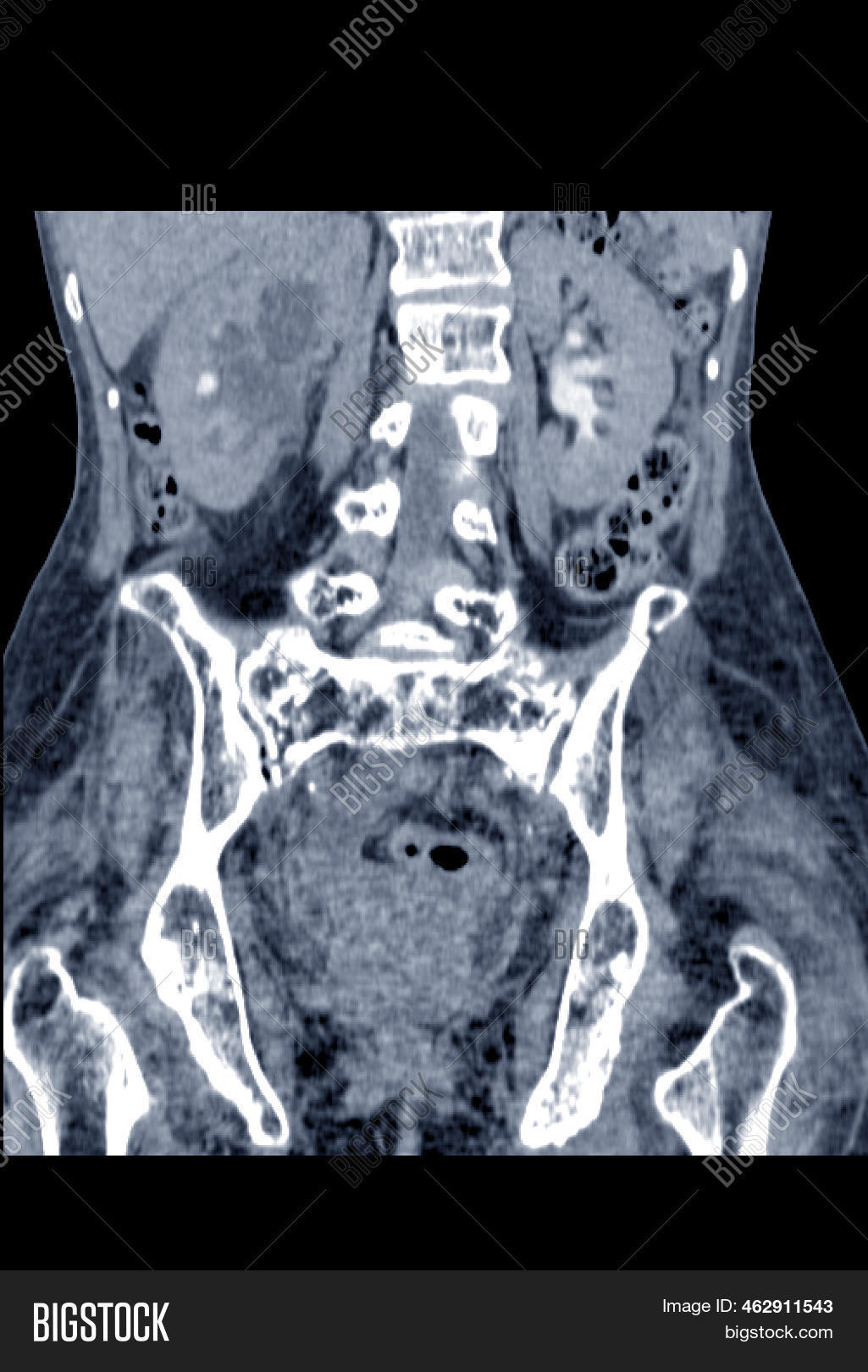 Blurry Ct Scan Lower Image & Photo (Free Trial) | Bigstock