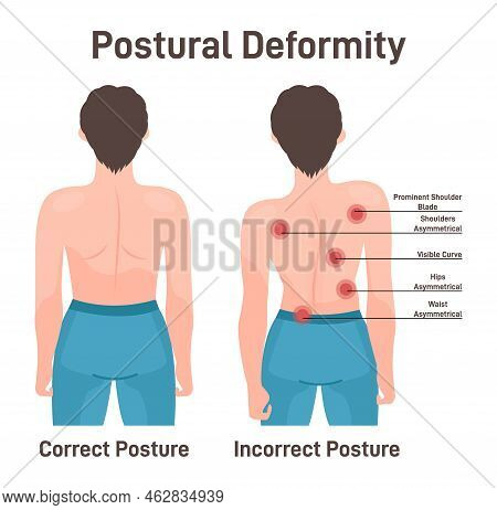 Postural Deformity. Vector & Photo (Free Trial) | Bigstock