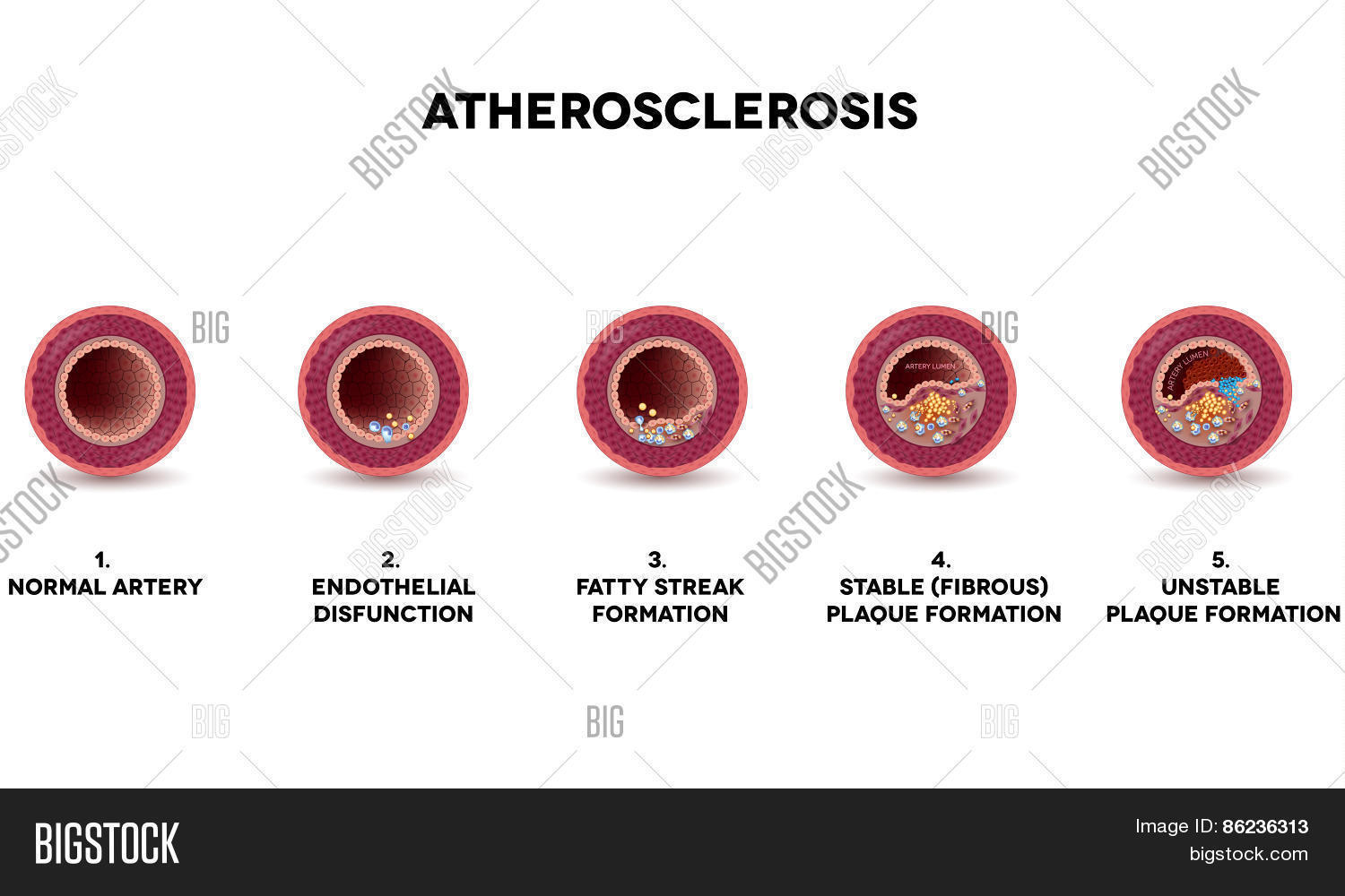 Atherosclerosis Vector & Photo (Free Trial) | Bigstock