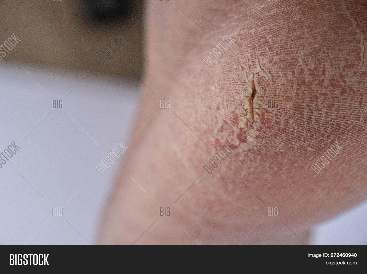Cracked Heels . Severe Image & Photo (Free Trial) | Bigstock