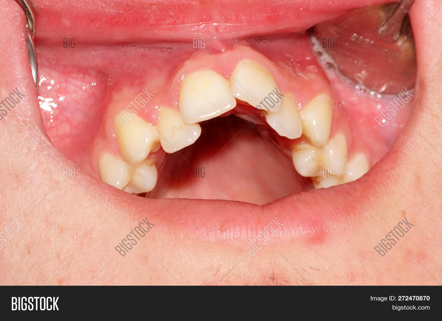 Malocclusion. Crowding Image & Photo (Free Trial) | Bigstock