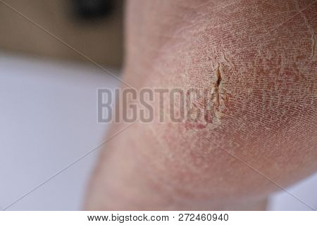 Cracked Heels . Severe Image & Photo (Free Trial) | Bigstock
