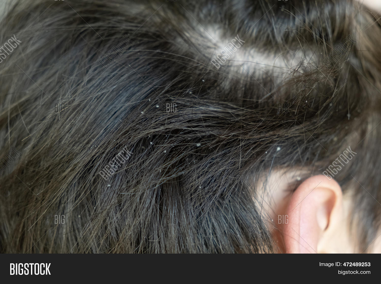 Dandruff in kids store