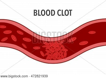 Blood Clot Vein Flat Vector & Photo (Free Trial) | Bigstock