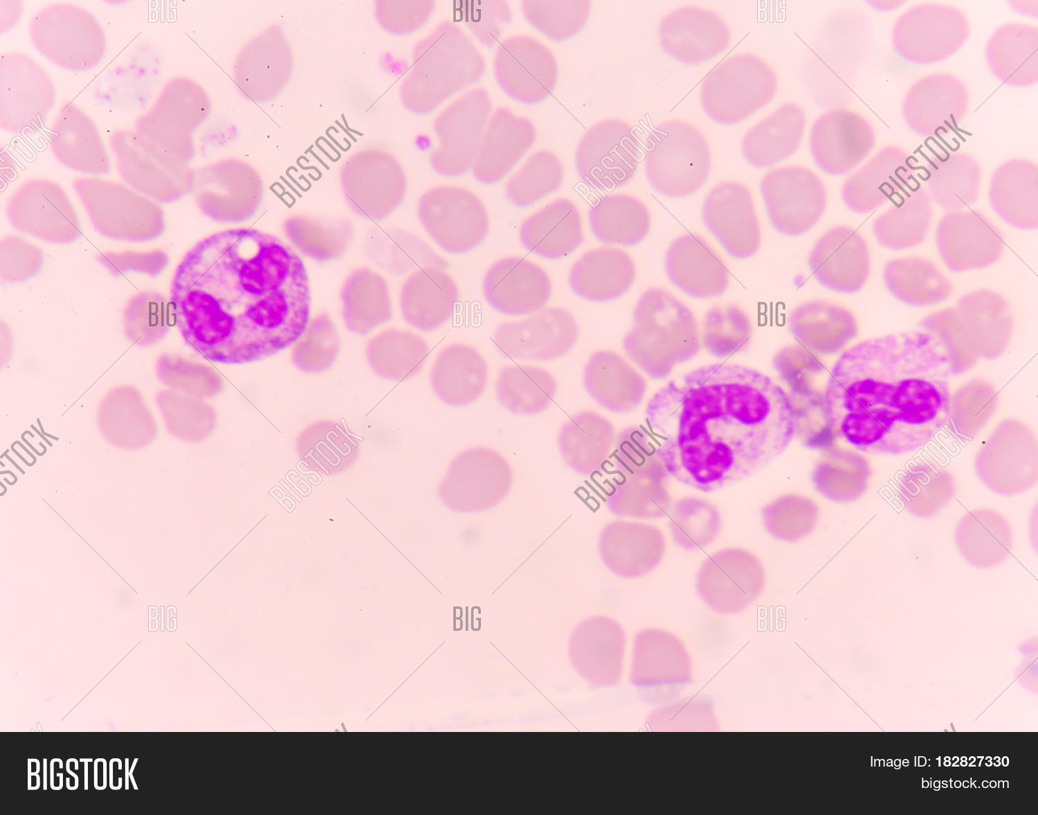 Abnormal Neutrophil Image & Photo (Free Trial) | Bigstock