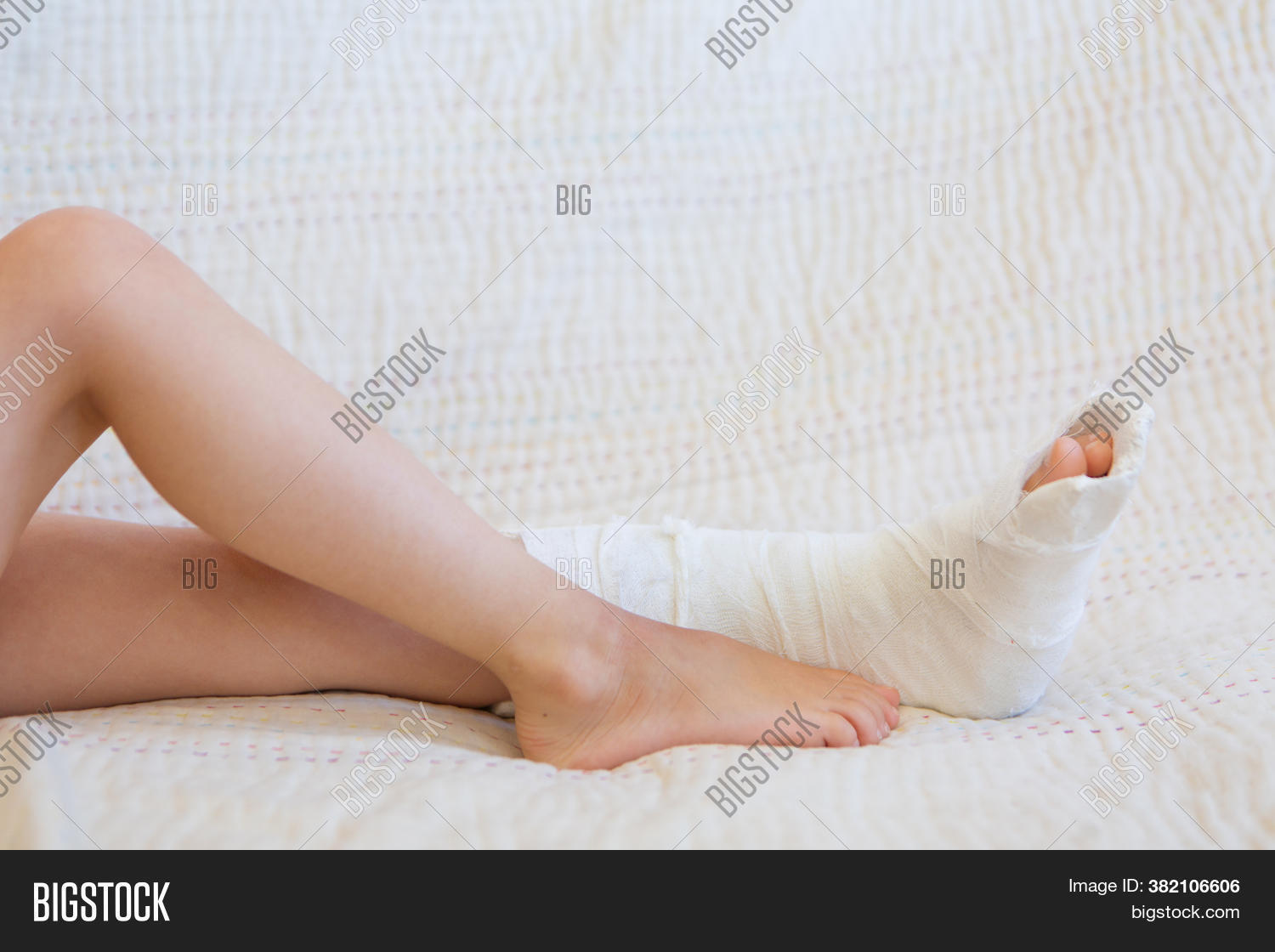 Broken Leg. Close- Image & Photo (Free Trial) | Bigstock