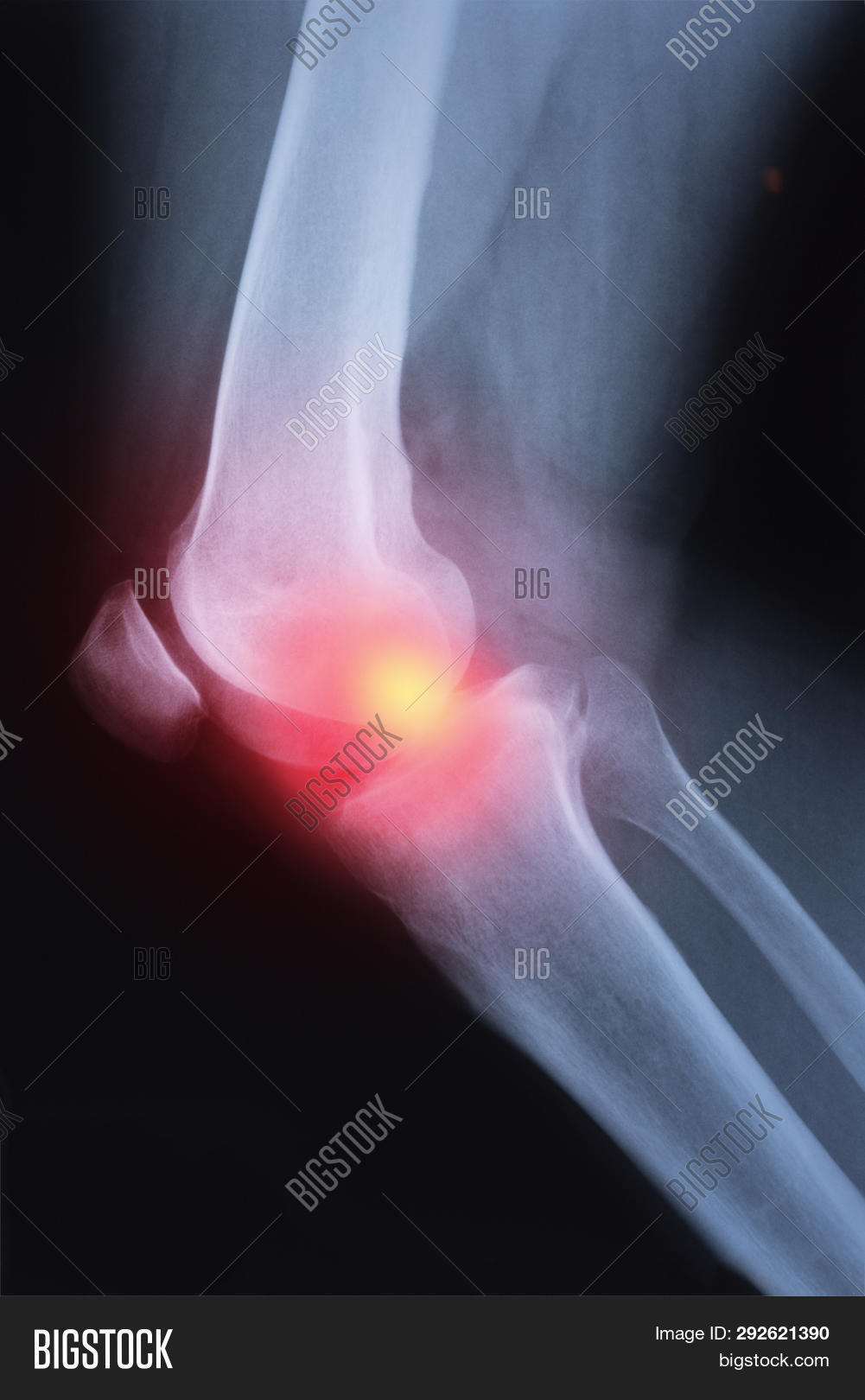 Xray Of Broken Knee