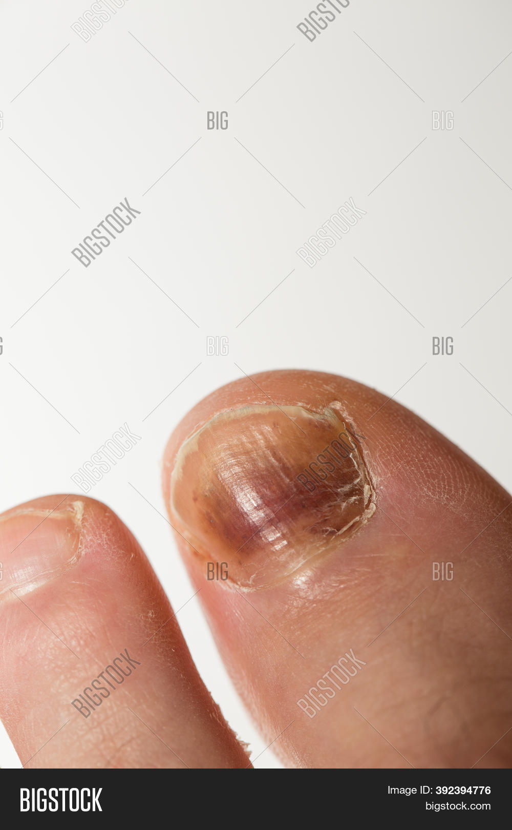 Bruised Finger After Image & Photo (Free Trial) | Bigstock
