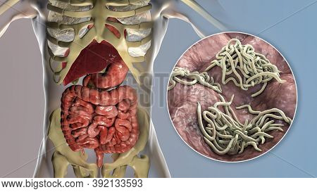 Parasitic Worms Human Image & Photo (Free Trial) | Bigstock