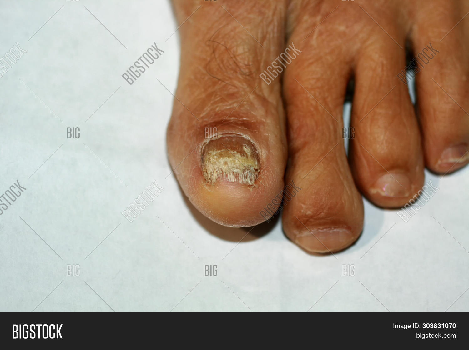 Fungus On Big Toe. Image & Photo (Free Trial) | Bigstock