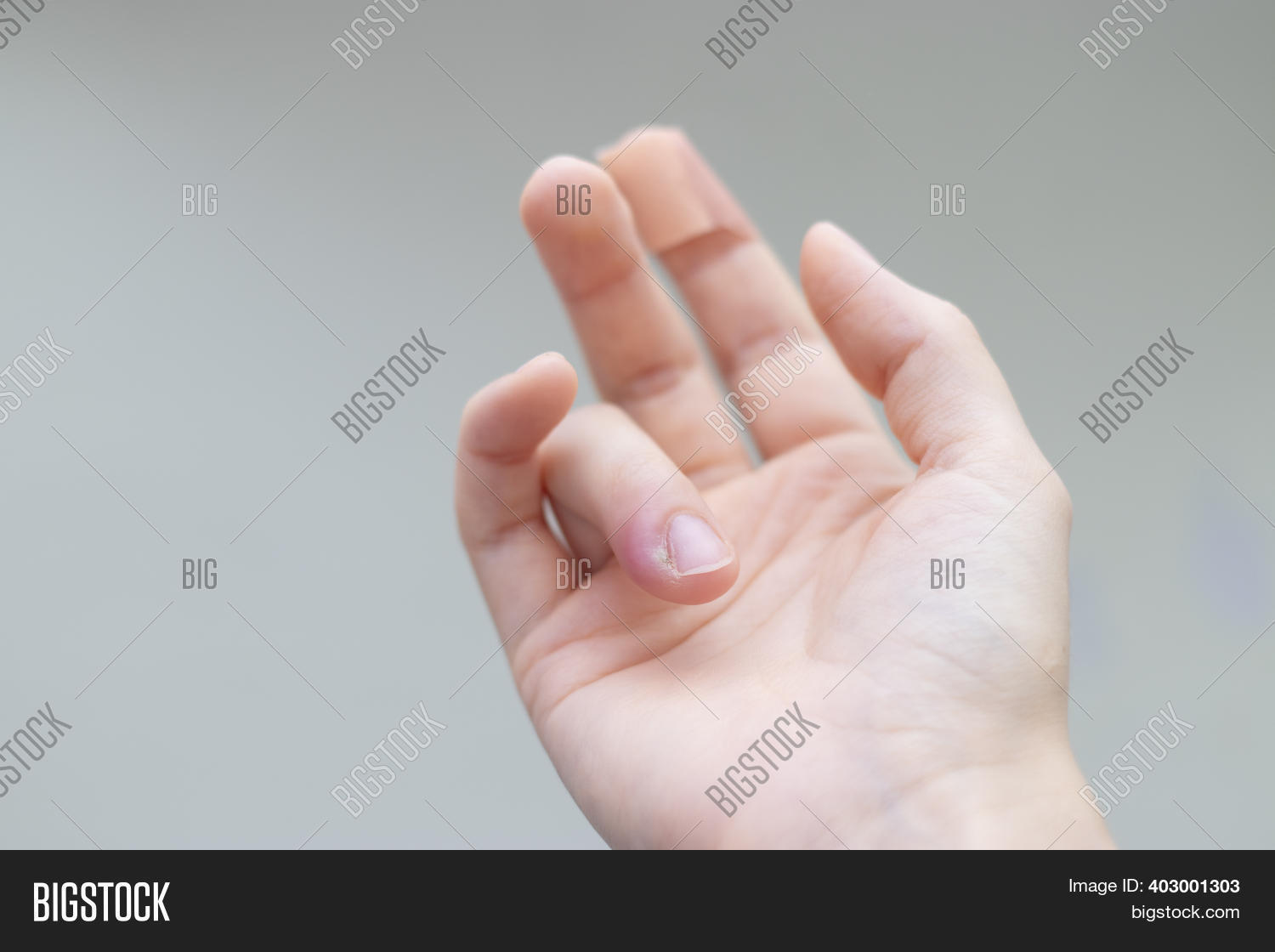 Abscess On Finger. Image & Photo (Free Trial) | Bigstock