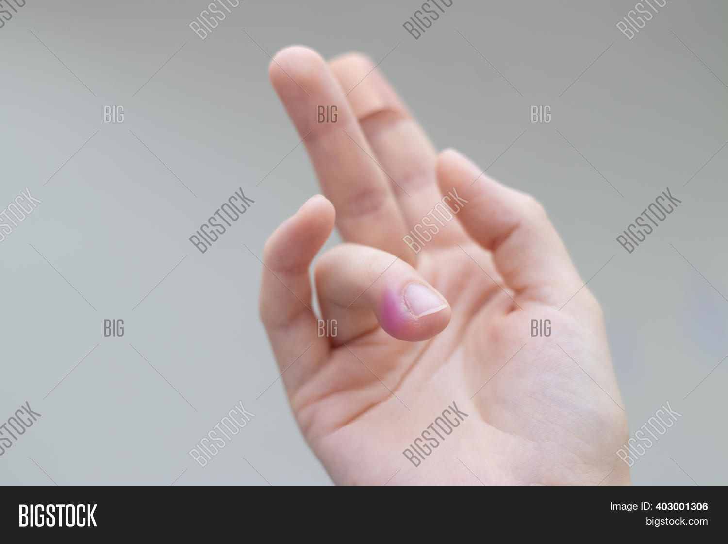 Abscess On Finger. Image & Photo (Free Trial) | Bigstock