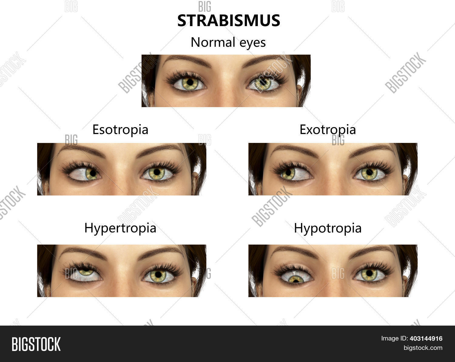 Strabismus, 3d Image & Photo (Free Trial) | Bigstock