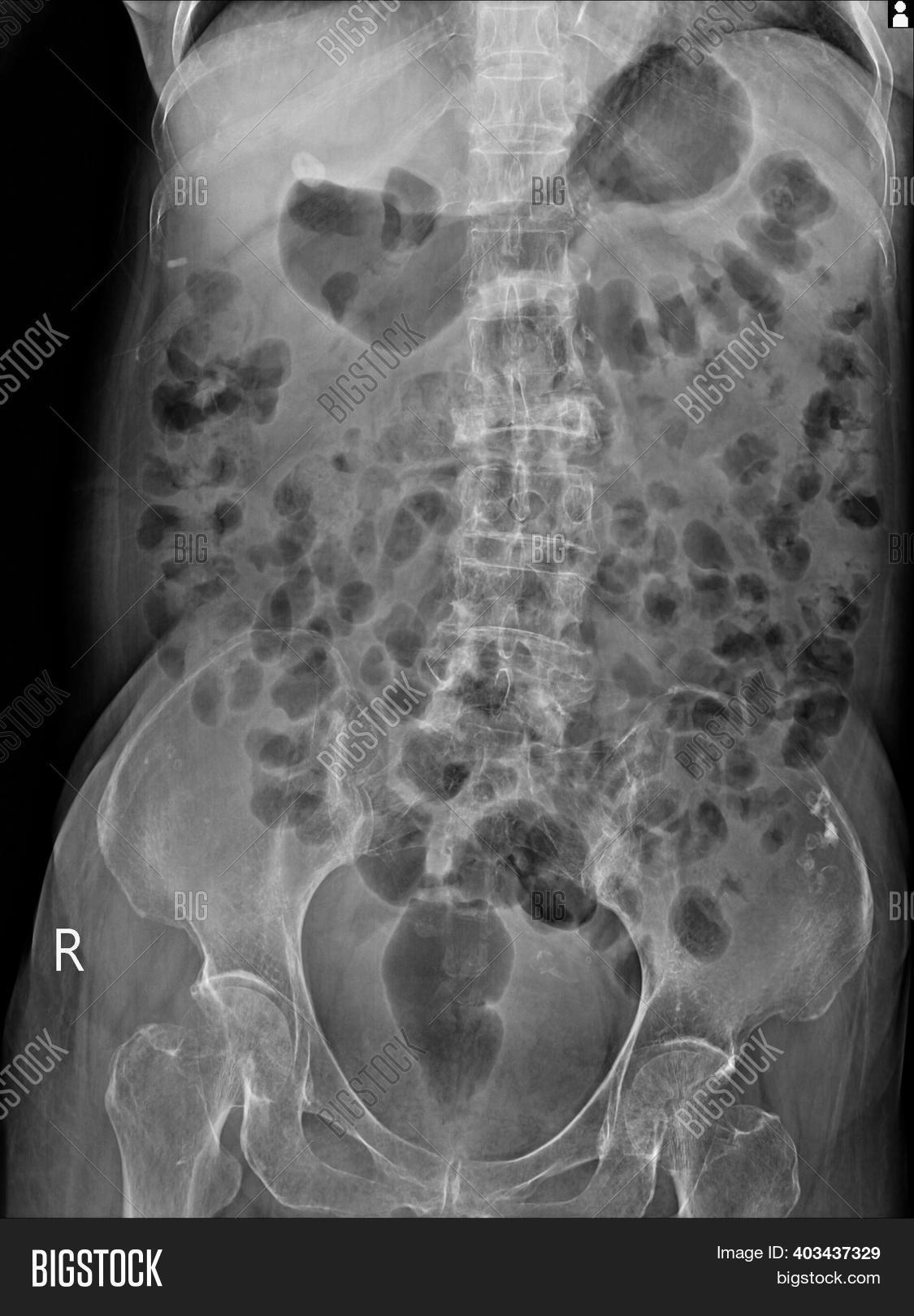 X-ray Lumbar Spine Image & Photo (Free Trial) | Bigstock